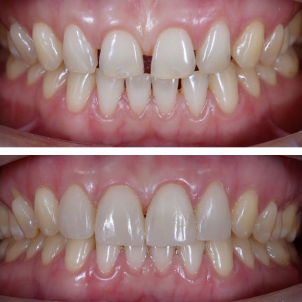 Odessa Cosmetic Dentist | Dentist in Lutz FL | Before & After Dentistry
